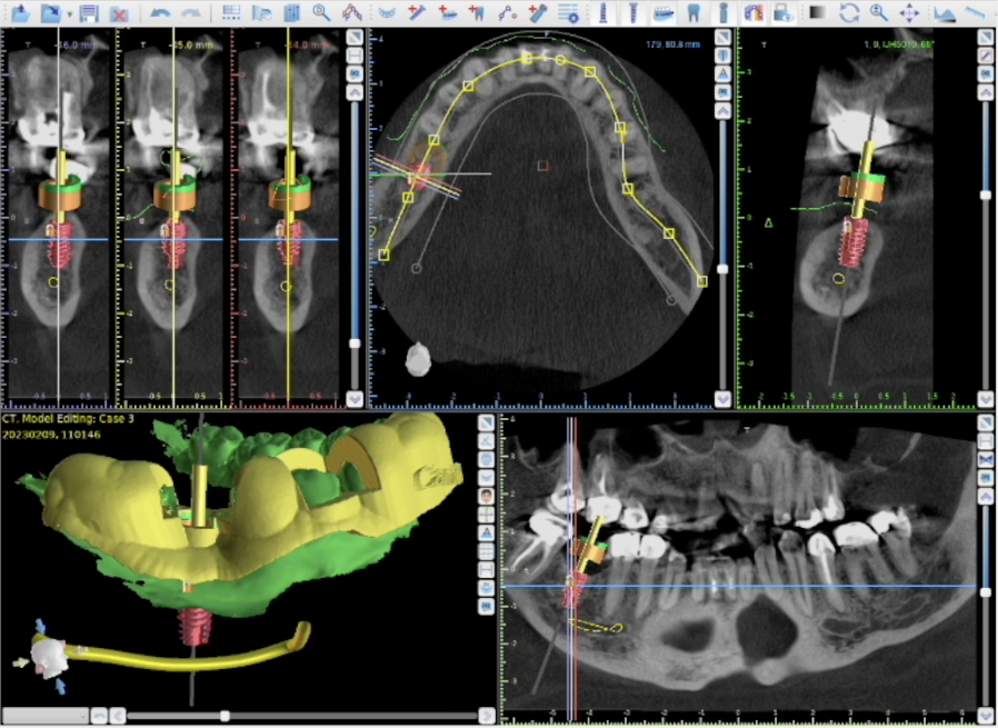 Full Arch on 4 or 6 Dental Implants Dublin | IDC Approved Dentists